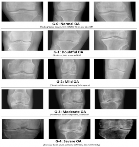 Automatic Detection of Knee Osteoarthritis Disease with the Developed ...