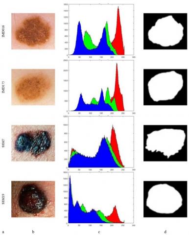 An Automatic Region Based Optimal Segmentation and Detection of Features on Dermoscopy Images ...