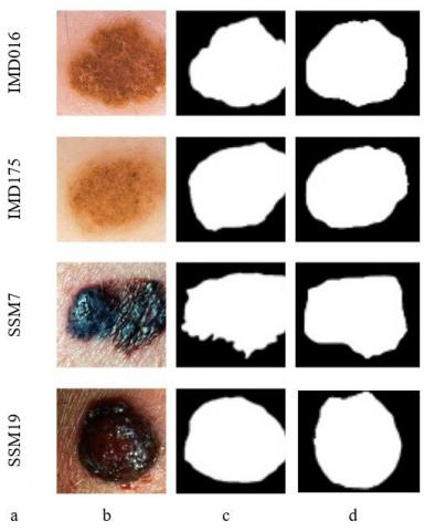 An Automatic Region Based Optimal Segmentation and Detection of Features on Dermoscopy Images ...