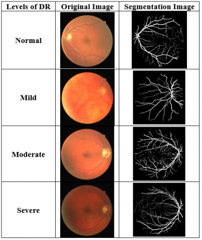 An Approach to Classify and Segment Diabetic Retinopathy and ...
