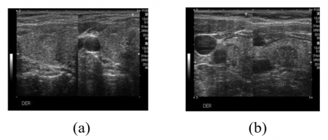 Classification of Thyroid Nodules Using Follow the Regularized Leader Optimization Based Deep ...
