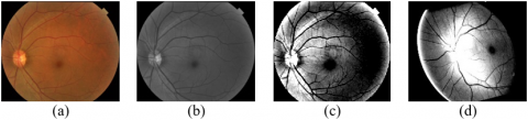 Enhancing Cataract Detection Precision: A Deep Learning Approach | IIETA