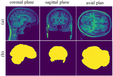 Advances in Brain Tumor Segmentation and Skull Stripping: A 3D Residual Attention U-Net Approach ...