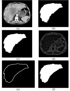 ESP-UNet: Encoder-Decoder Convolutional Neural Network with Edge-Enhanced Features for Liver ...