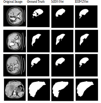 ESP-UNet: Encoder-Decoder Convolutional Neural Network with Edge-Enhanced Features for Liver ...