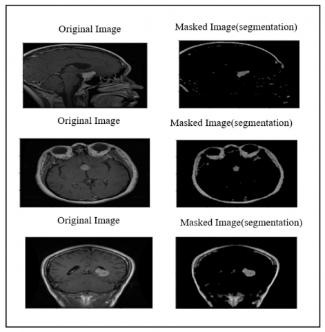 Automated Identification and Classification of Brain Tumors Using ...