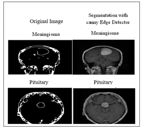 Automated Identification and Classification of Brain Tumors Using ...