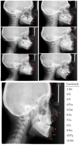 Advancing Cephalometric Soft-Tissue Landmark Detection: An Integrated ...